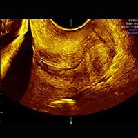 Cervical Scan - London Pregnancy Clinic